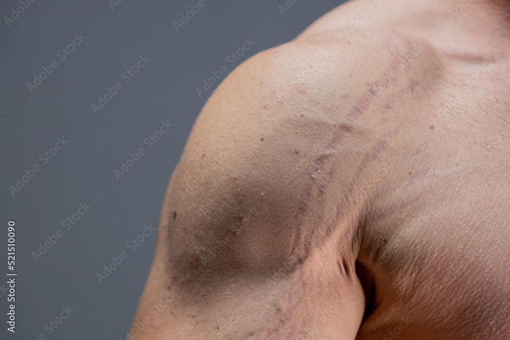 Photo Stock Close up view of the arm with striae distensae (striae ...