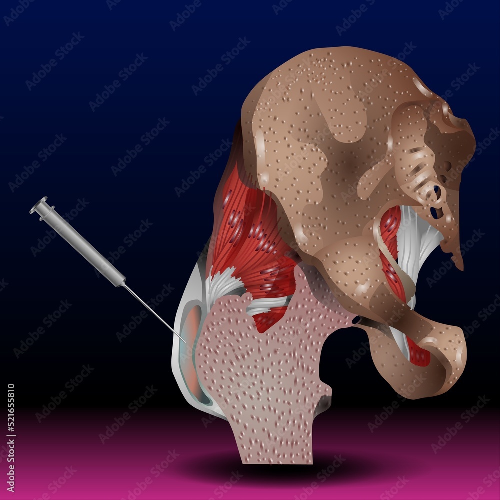Shoulder Bone Injection - Fla source file available - For the ...