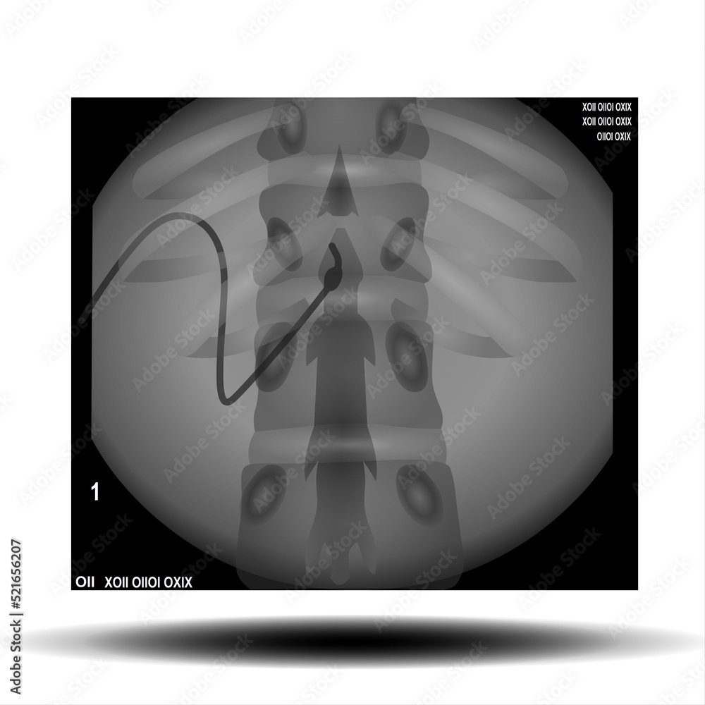 Spine X-ray on white background - Fla source file available - Scoliosis ...