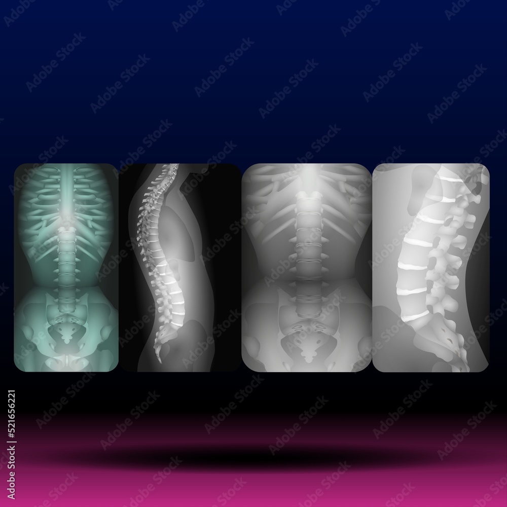 Spine X-rays - Fla source file available - Scoliosis is an abnormal ...