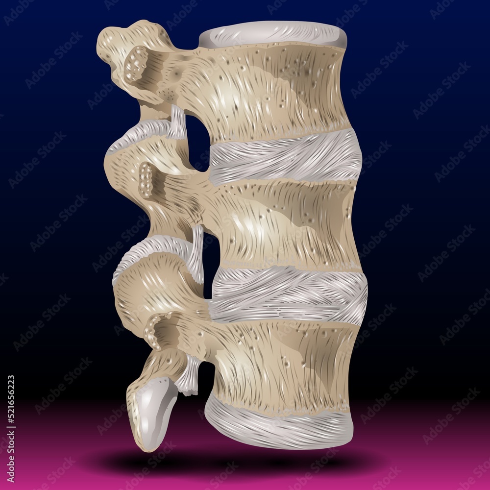 Spondylitis - Fla source file available - Ankylosing Spondylitis ...