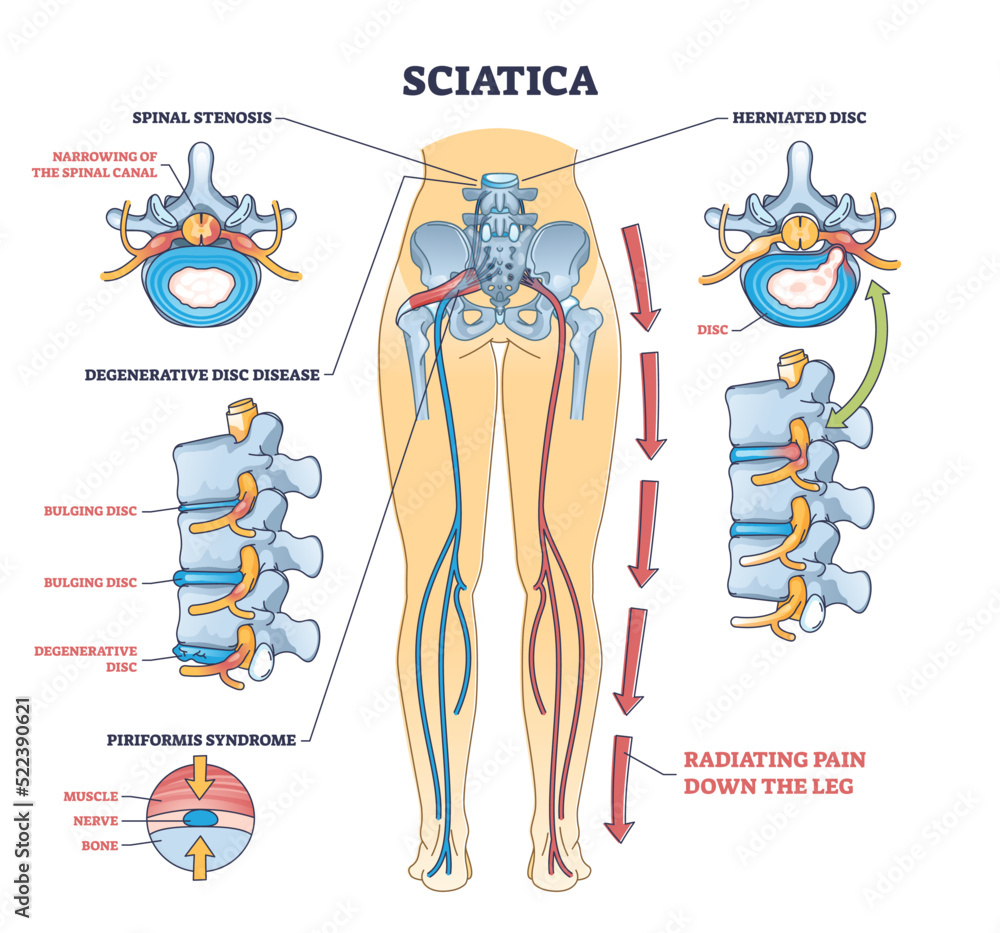 Sciatica pain or nerve weakness as leg lumbar radiculopathy outline ...
