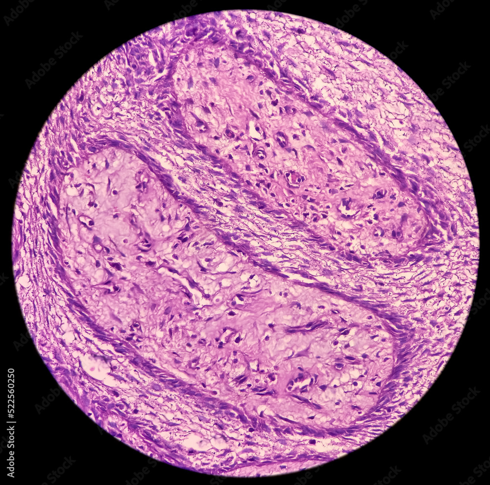 Microscopic tissue of retromolar region, show buccal mucosa, squamous ...