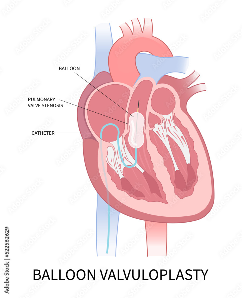 mitral valve disease the cardiac heart murmur of Cath lab for TAVI or ...