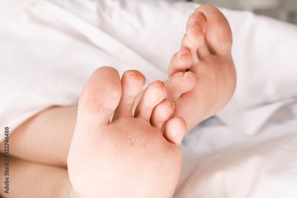 Corns and mycosis. Close-up of women's feet with calluses on each ...