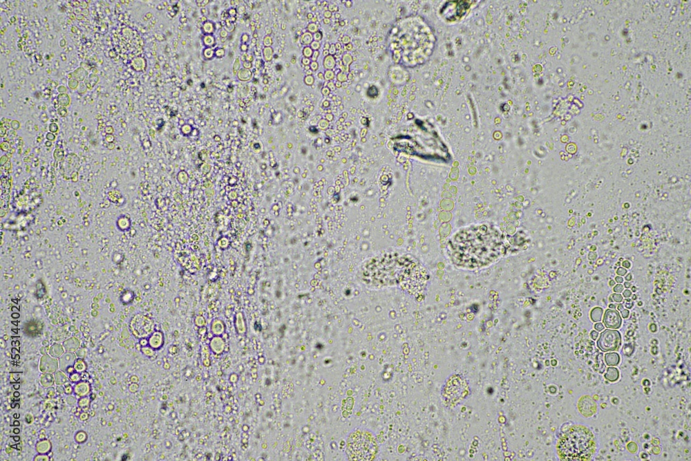 person with a virus coughing, Phlegm and mucus under the microscope ...