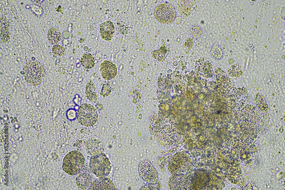 Photo Stock Coughing up mucus and phlegm from a chest infection from a ...