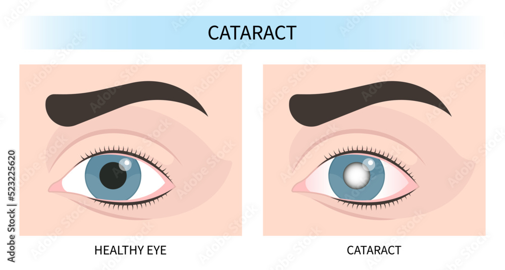 eye stye pain pink red surfer's blurry ulcer bacteria lens vision loss ...