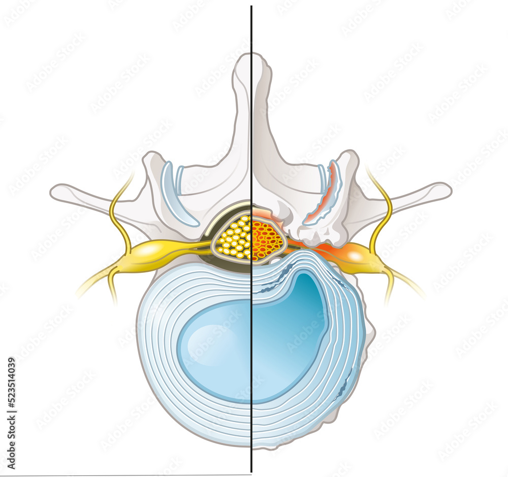 Spinal Canal Stenosis. Lumbar vertebra with intervertebral disc and ...