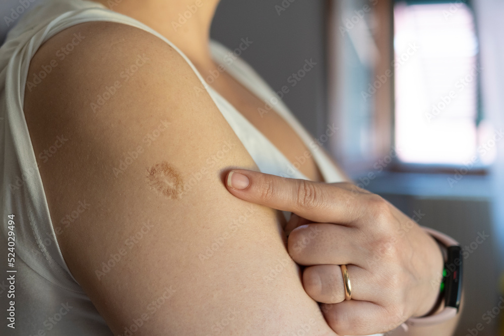 Monkeypox and smallpox vaccine concept: woman shows smallpox vaccine ...