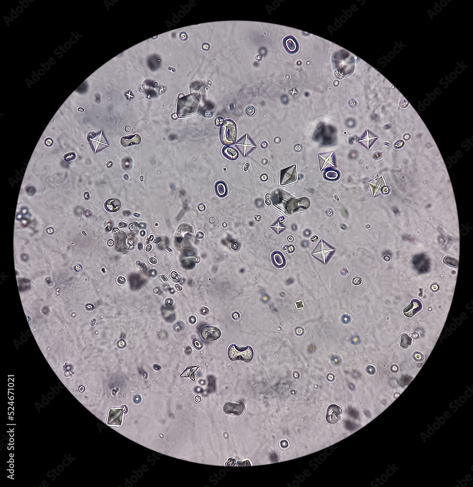 Microscopic image showing Calcium oxalate (monohydrate and dihydrate ...