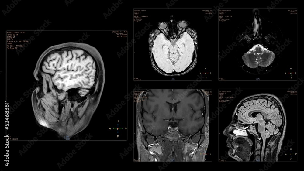 Head MRI scan from different angles. Top view and side view of brain ...