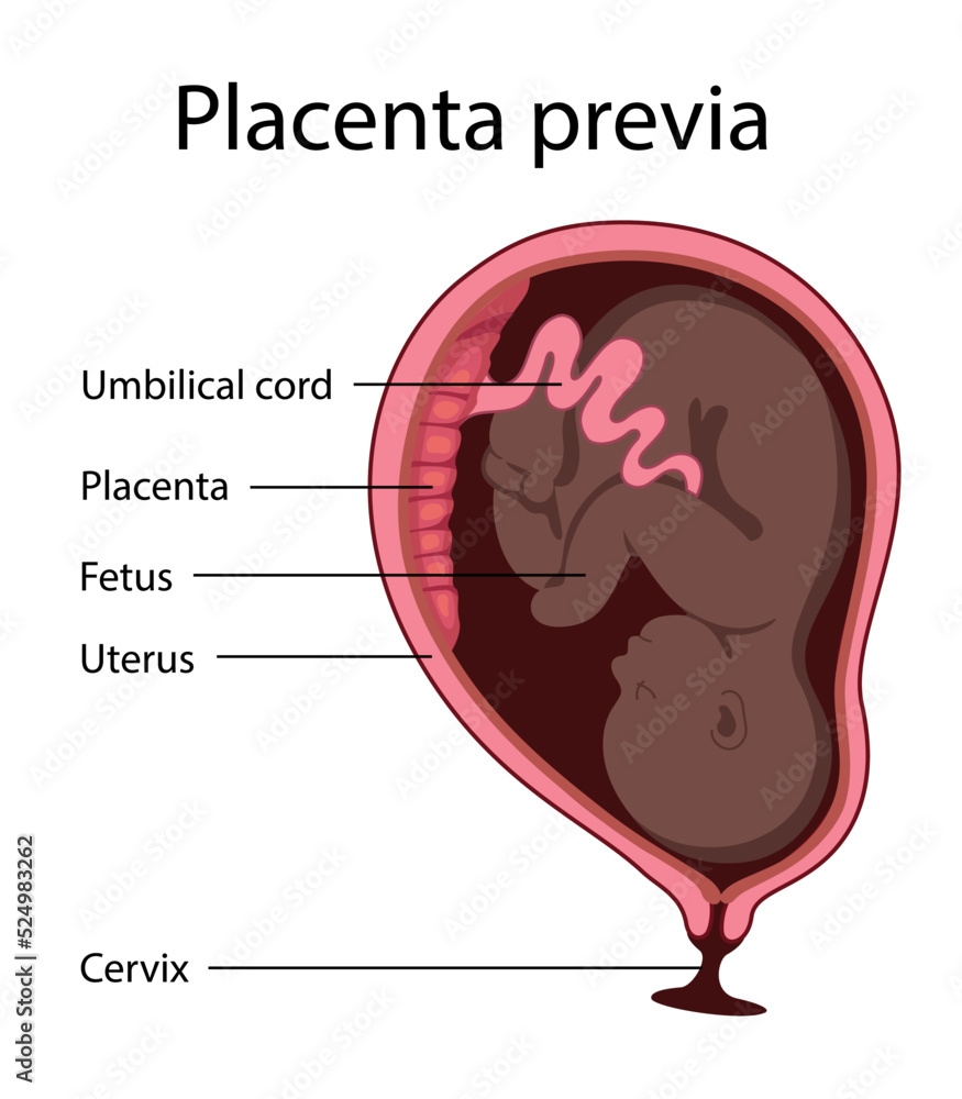 Placental previa. Fetus in Uterus During Pregnancy. Pregnancy women ...