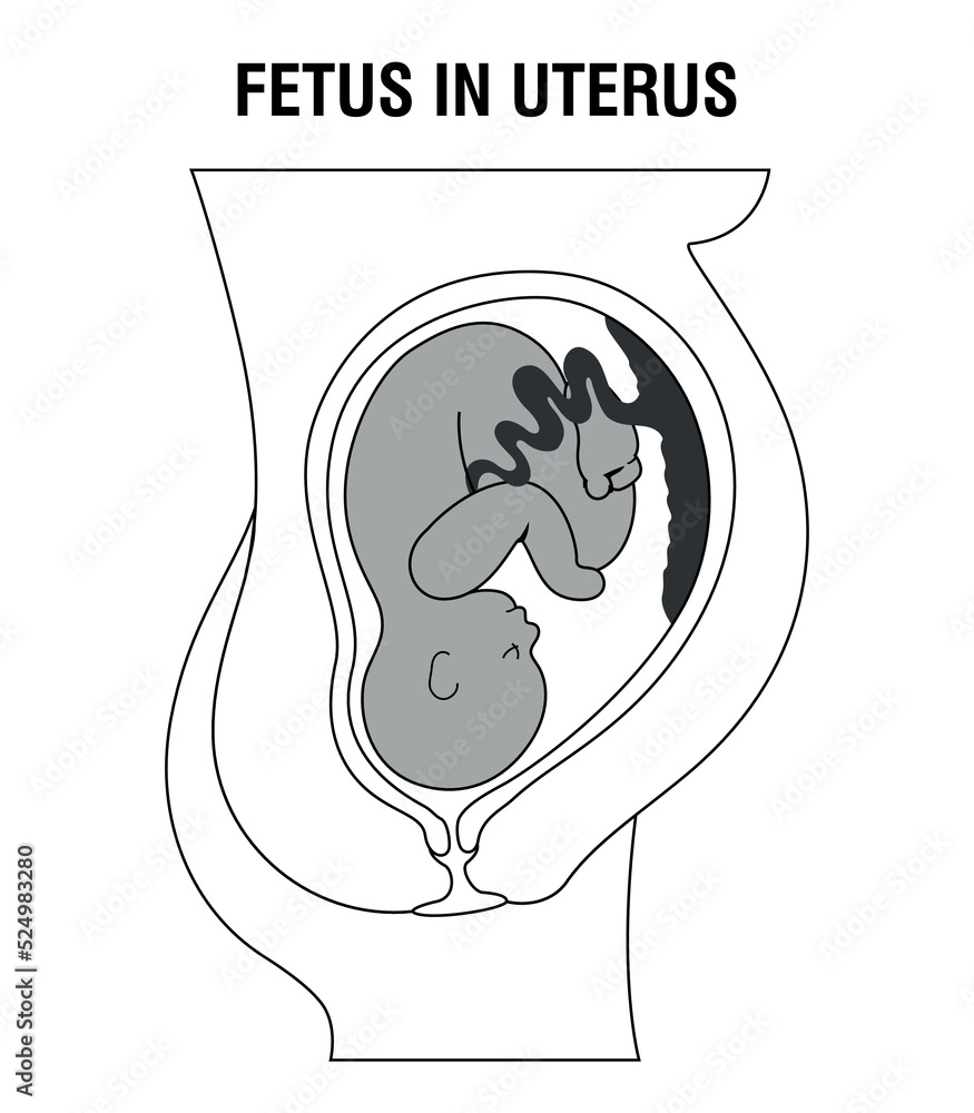 Placental previa. Fetus in Uterus During Pregnancy. Pregnancy women ...