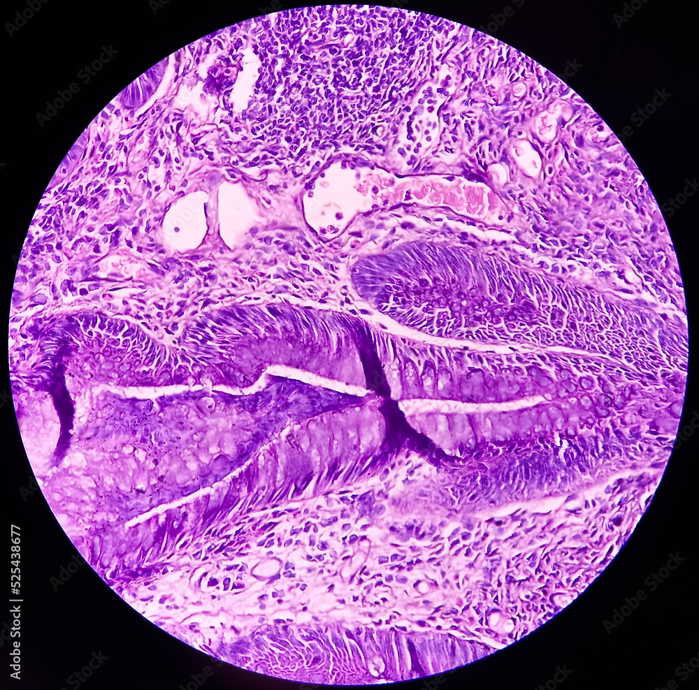 Wound area tissue: Foreign body reaction, show soft tissue, fatty ...