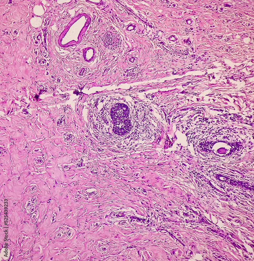Photomicrograph of breast abscess, Granulomatous mastitis, show dense ...