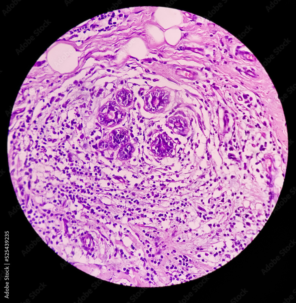 Photomicrograph of breast abscess, Granulomatous mastitis, show dense ...