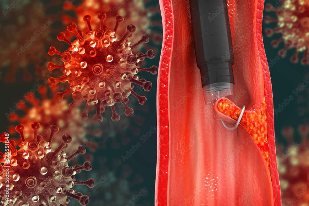 Colon cancer. Colon Polyp Removal. Endoscope inside colonoscopy for ...