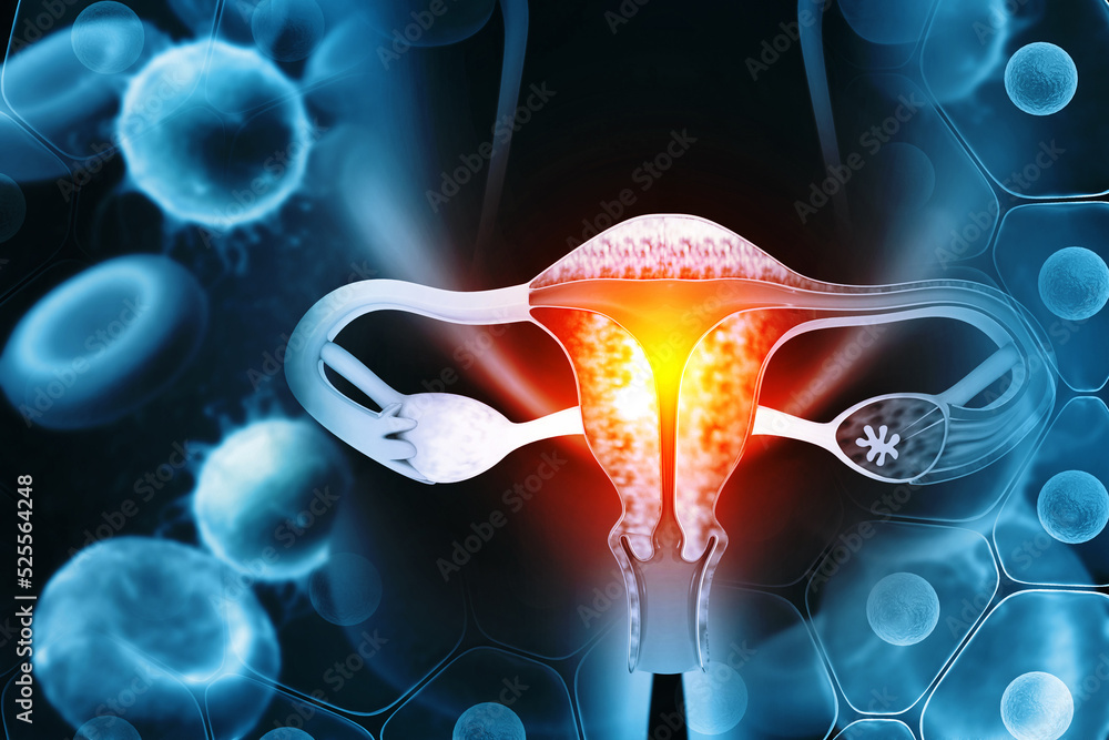 Female reproductive system diseases. Uterus cancer and endometrial ...