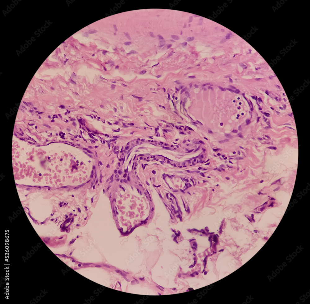 Knee joint(biopsy): Ganglion cells, show microscopic view cyst wall ...