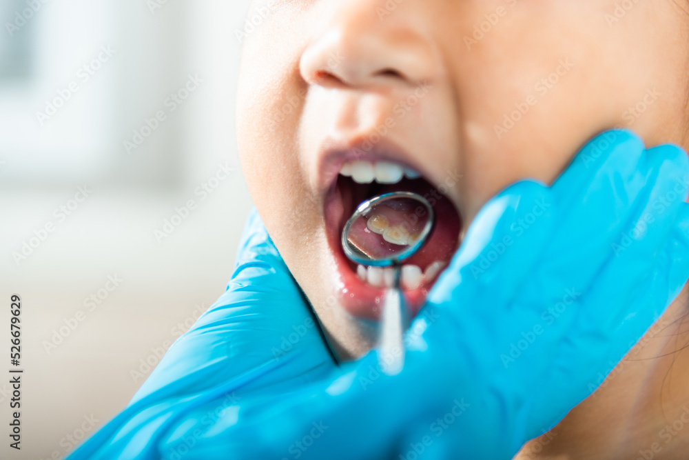 Dental kid health examination. Doctor examines oral cavity of little child uses mouth mirror to ...