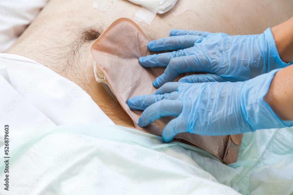 Close up stoma and colostomy after colon cancer surgery out.Cover stoma ...