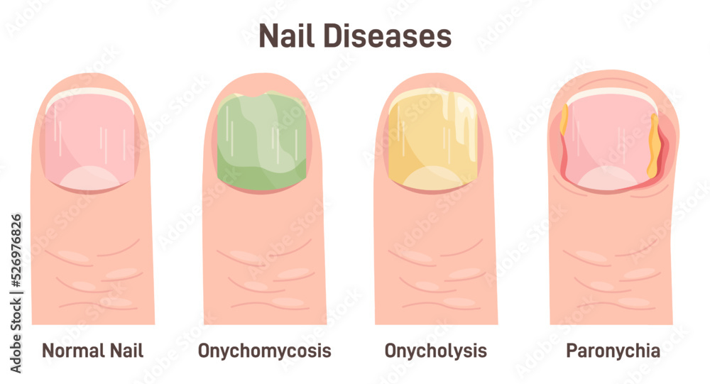 Onychomycosis, onycholysis, paronychia. Nail diseases, nail fungal ...