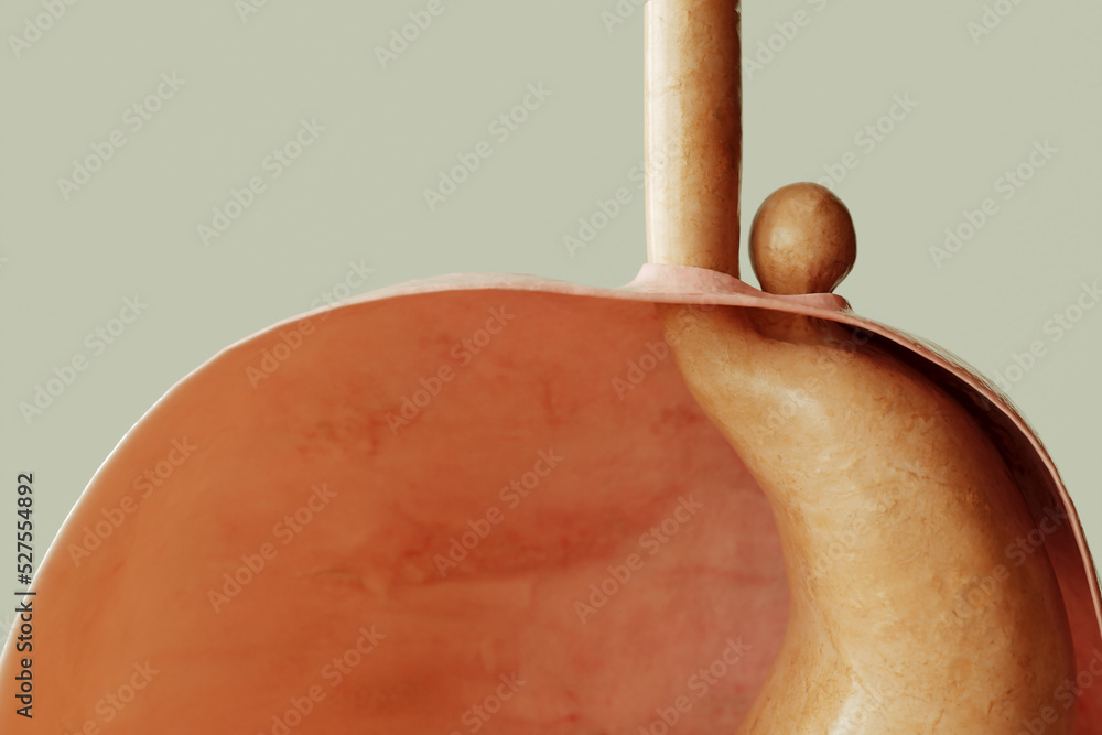 Paraesophageal Hiatus Hernia Type 2 - Stomach protrusion through ...