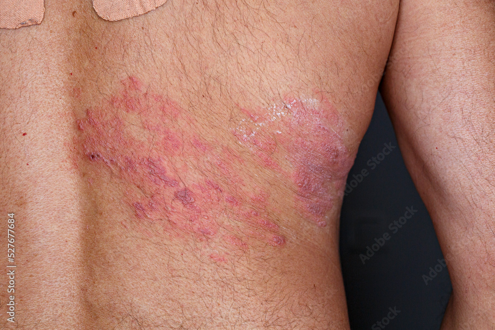 Skin lesion symptom in Shingles or Herpes zoster in human. Shingles or ...