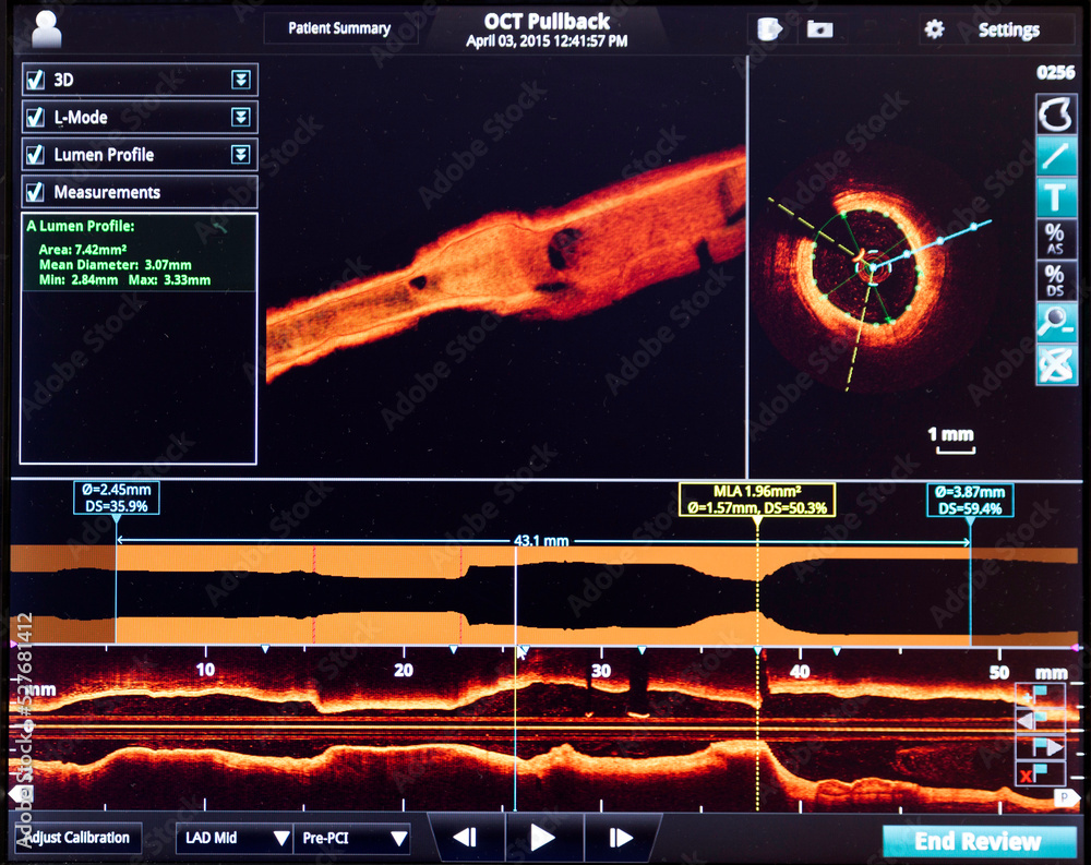 intravascular optical coherence tomography oct image angiography ...