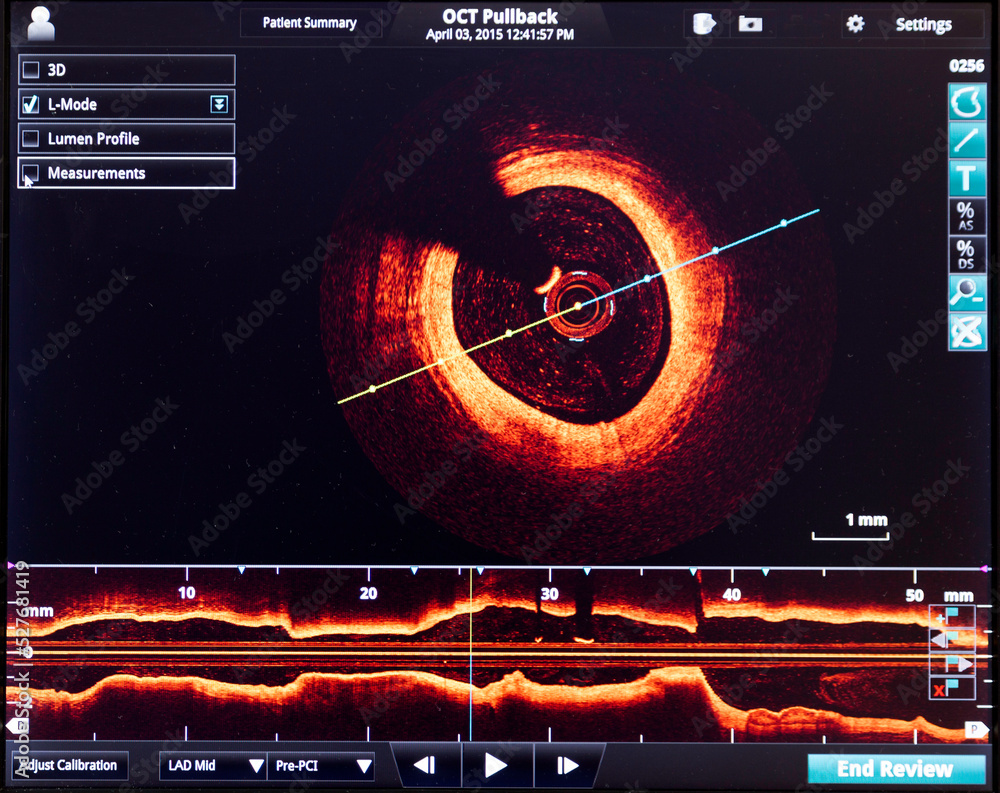 Intravascular optical coherence tomography oct image angiography ...