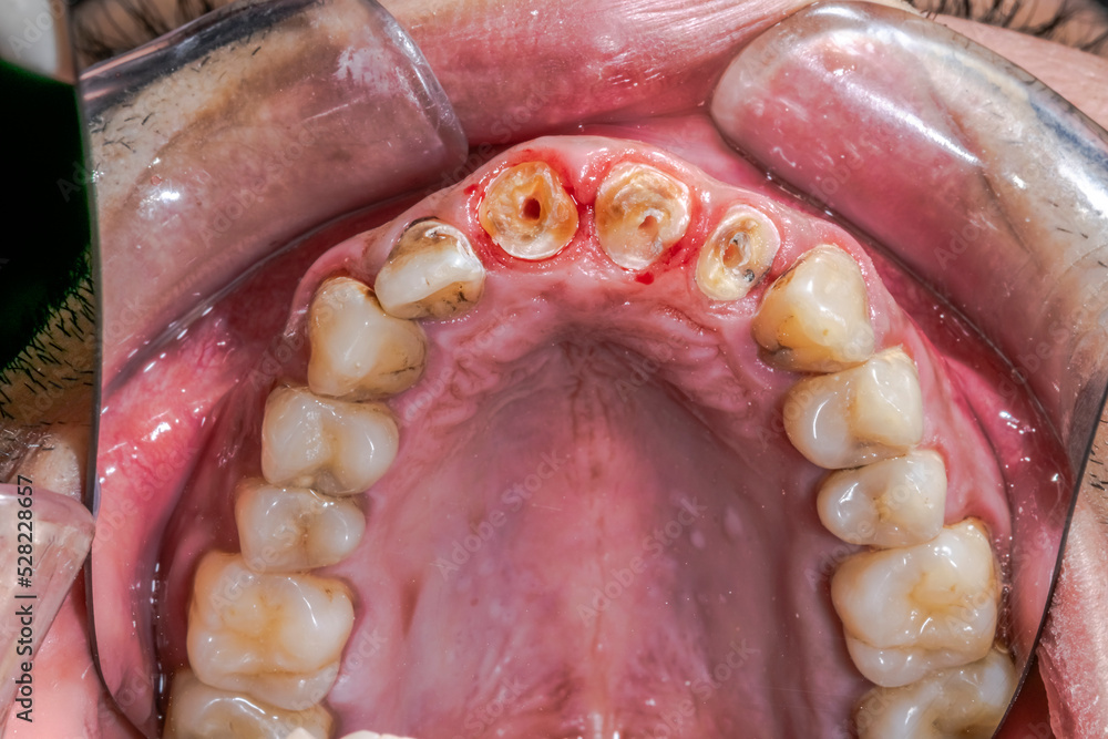 Foto de Stock Occlusal view of maxillary arch with unhealthy decayed ...