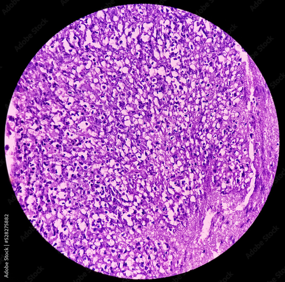 Suppurative cholecystitis of Gallbladder, show perimuscular fibrosis ...