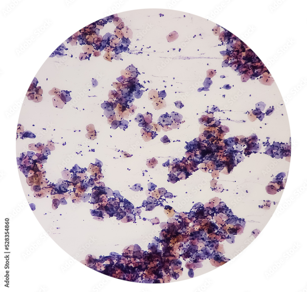 Abnormal squamous epithelial cells view in microscopy.HPV criteria for ...