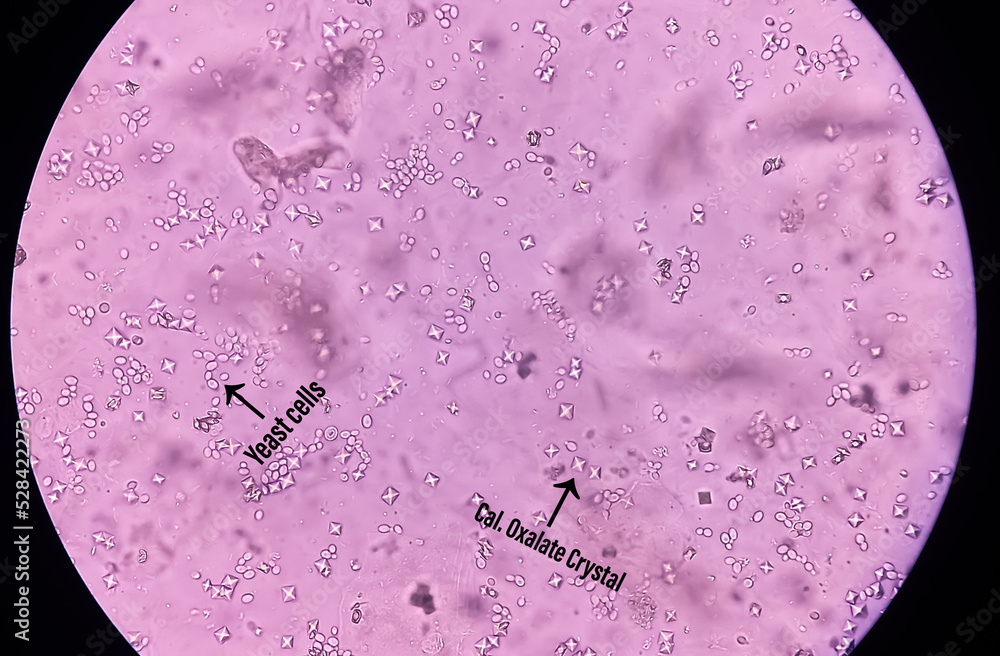 Budding yeast cells and calcium oxalate crystal in urine, urinary tract ...