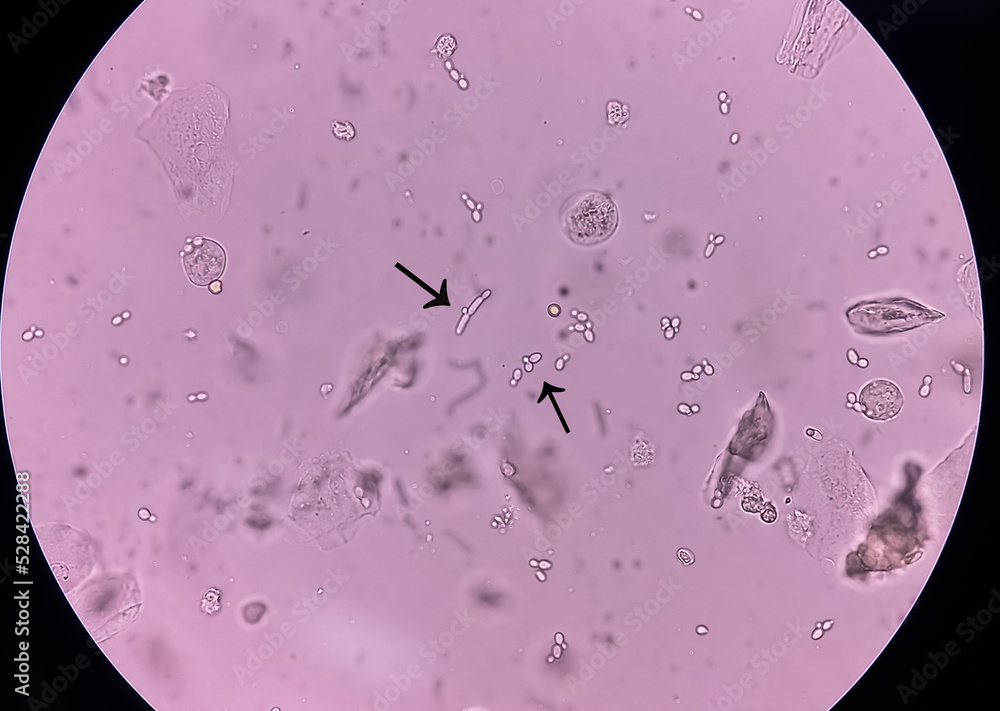 Budding yeast cells in patient urine (urinary tract infections), analyze by microscope, contrast ...