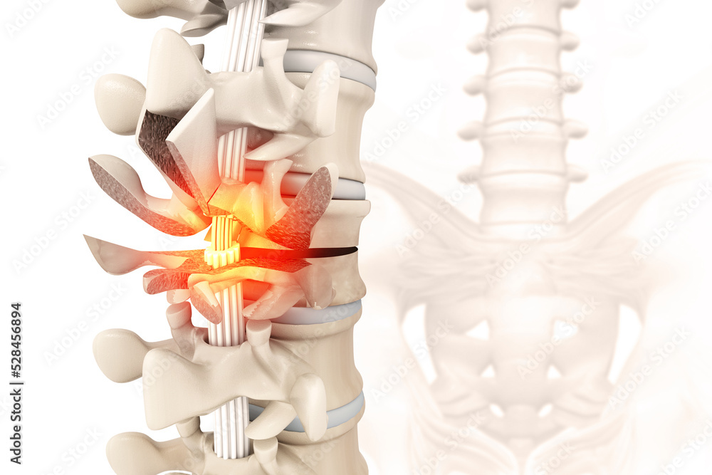 Spinal Fracture and traumatic vertebral injury. 3d illustration Stock ...