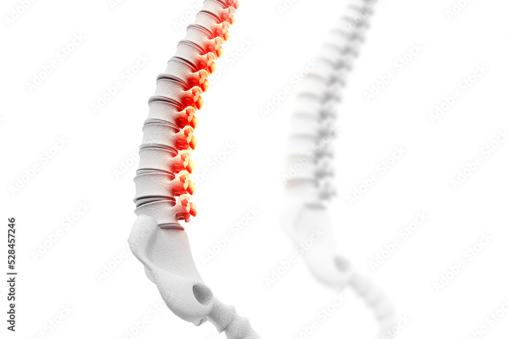 Lumbar intervertebral spine hernia. Spinal Fracture and traumatic ...