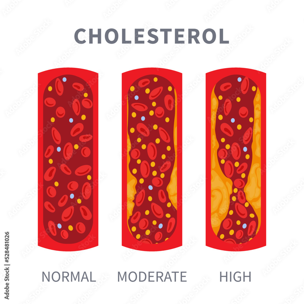 Healthy and narrowed blood vessel with cholesterol plaque buildup ...