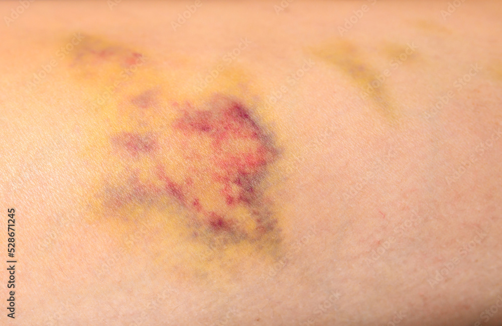 Bruises on the human body. Severe bruise from impact, bruising and hematoma. Stock Photo | Adobe ...