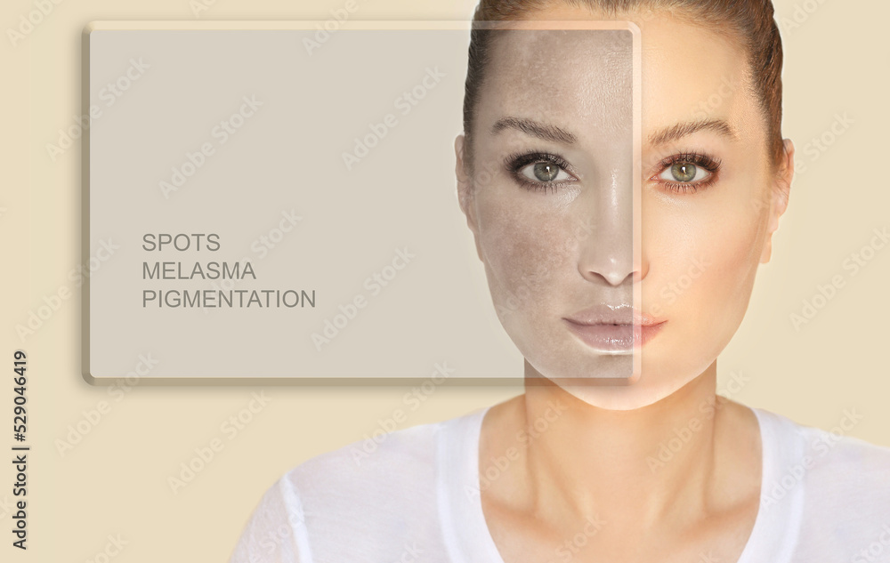 Dark spots, freckles,hyperpigmentation(melasma or chloasma),concept - skin lightening, skin ...