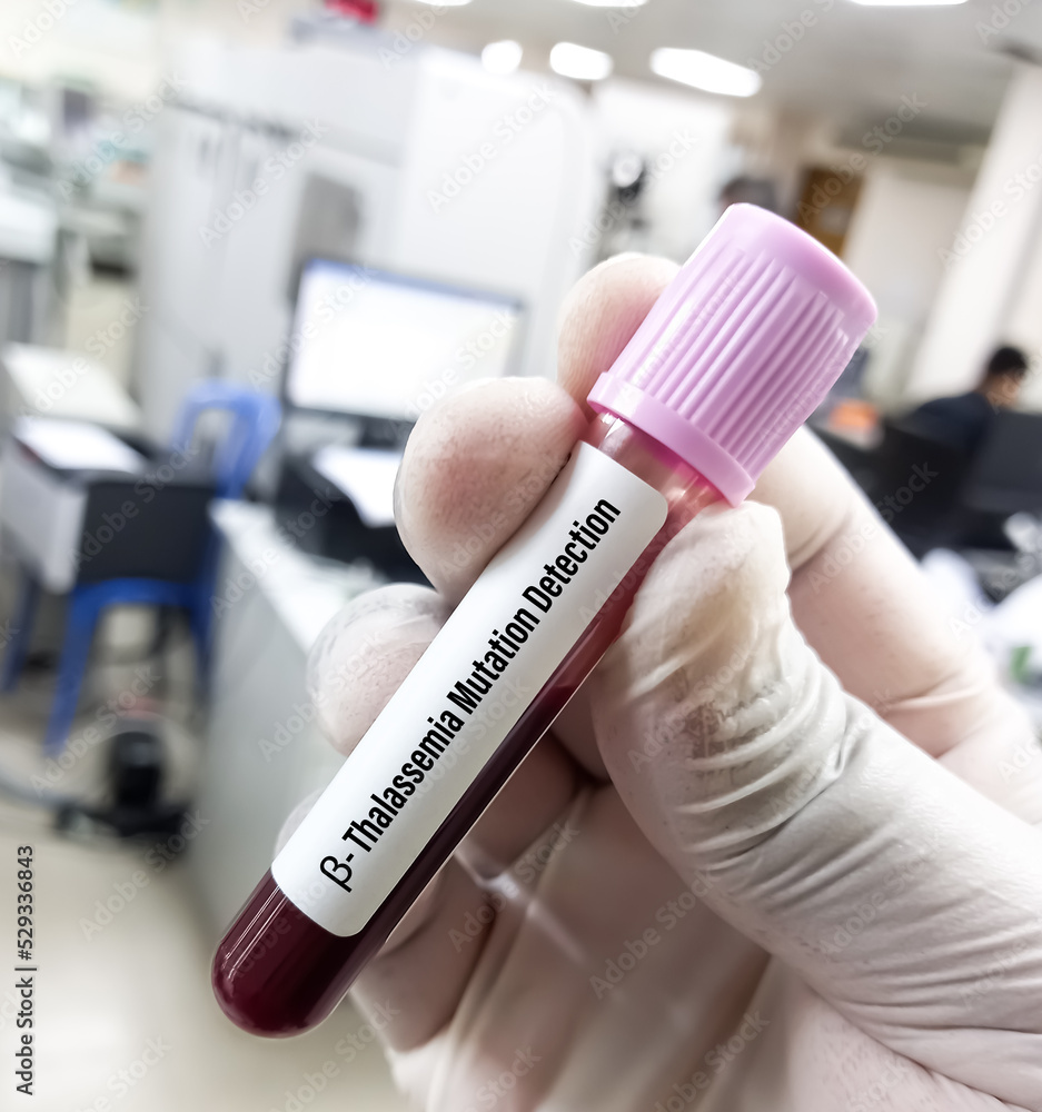 Scientist holding blood sample for beta thalassemia mutation detection ...