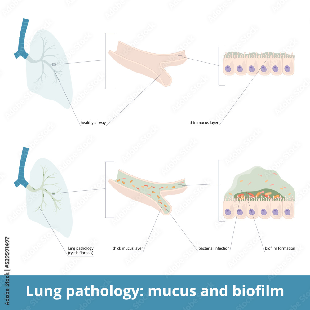 Common lung pathology and excessive mucus. Diseases (cystic fibrosis ...