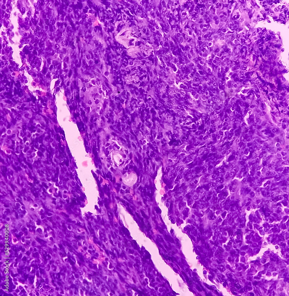 Supraclavicular lymph node biopsy: Microscopic image showing benign ...