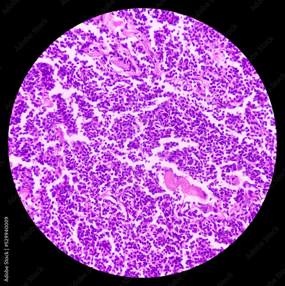 Supraclavicular lymph node biopsy: Microscopic image showing benign ...