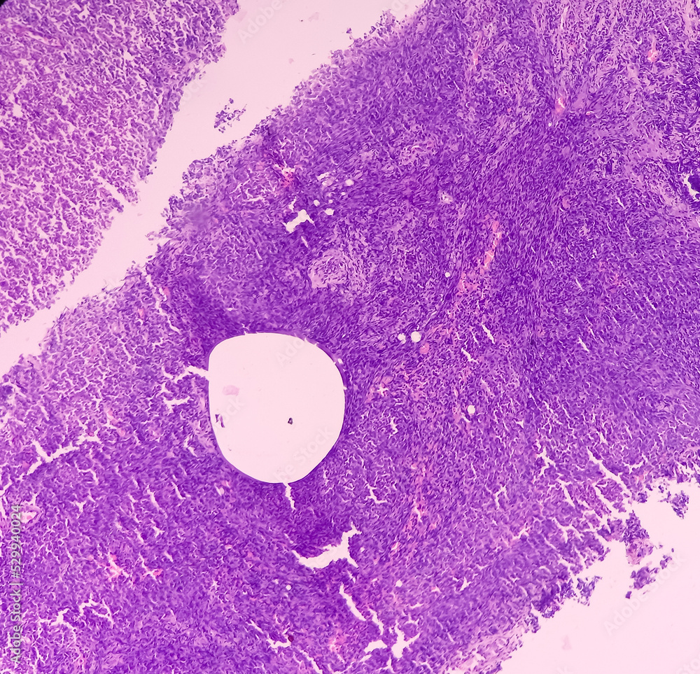 Supraclavicular lymph node biopsy: Microscopic image showing benign ...