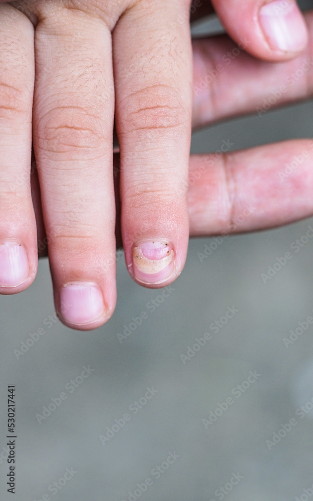 Mechanical damage to the nail plate. Nail Changes Occurring Secondary ...