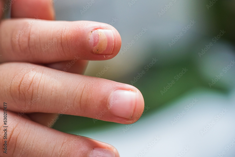 Mechanical damage to the nail plate. Nail Changes Occurring Secondary ...