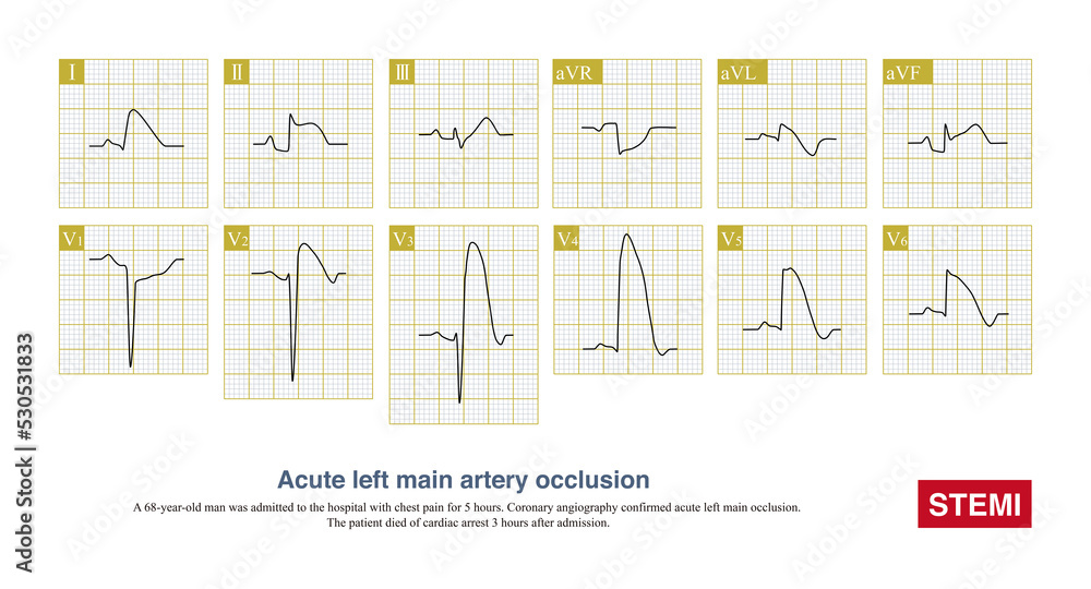 Acute left main artery occlusion can cause both ST segment elevation ...