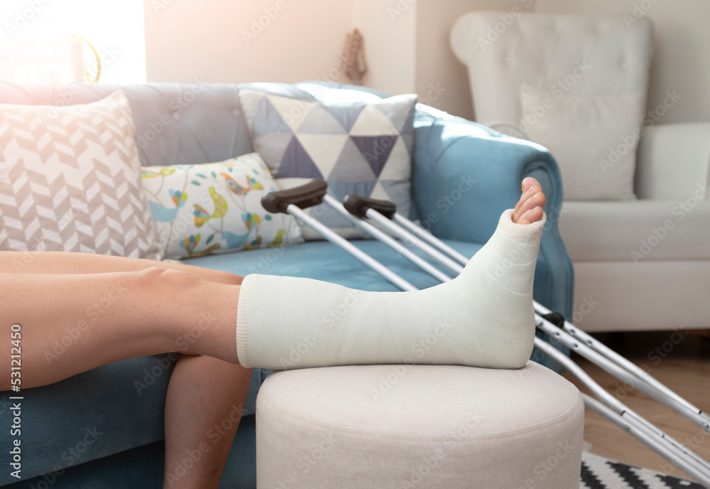 broken ankle and a leg cast. Leg splint Stock Photo | Adobe Stock